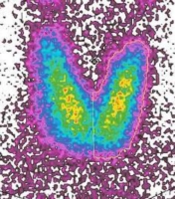 Január: a pajzsmirigybetegek hónapja - Pajzsmirigybetegség a ...